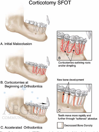 IN MÁNG HƯỚNG DẪN PHẪU THUẬT HỖ TRỢ CHỈNH NHA – Corticotomy